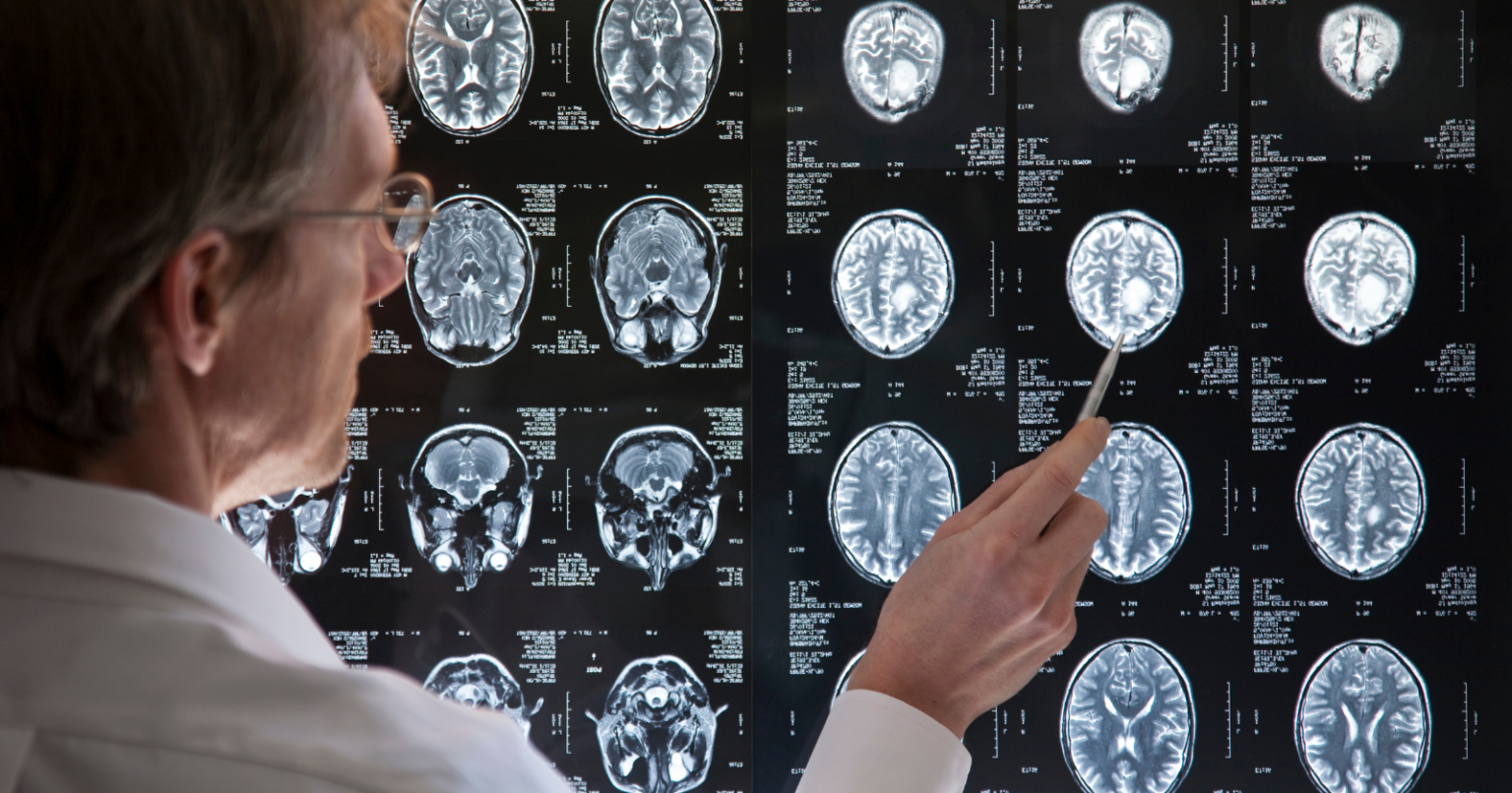 8 surprising facts about the effects of LSD on the brain